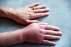 Diabetes swollen hand? What are you going to do about it? | Diabetes ...