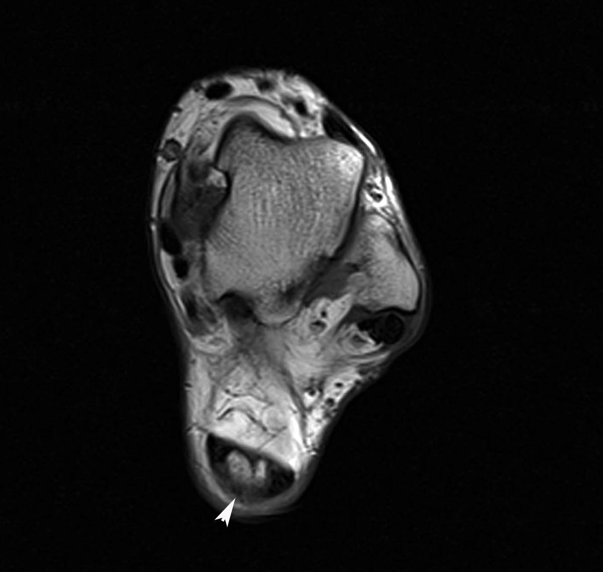 Mri Musculo Skeletal Section Achilles Tendonitis Mri