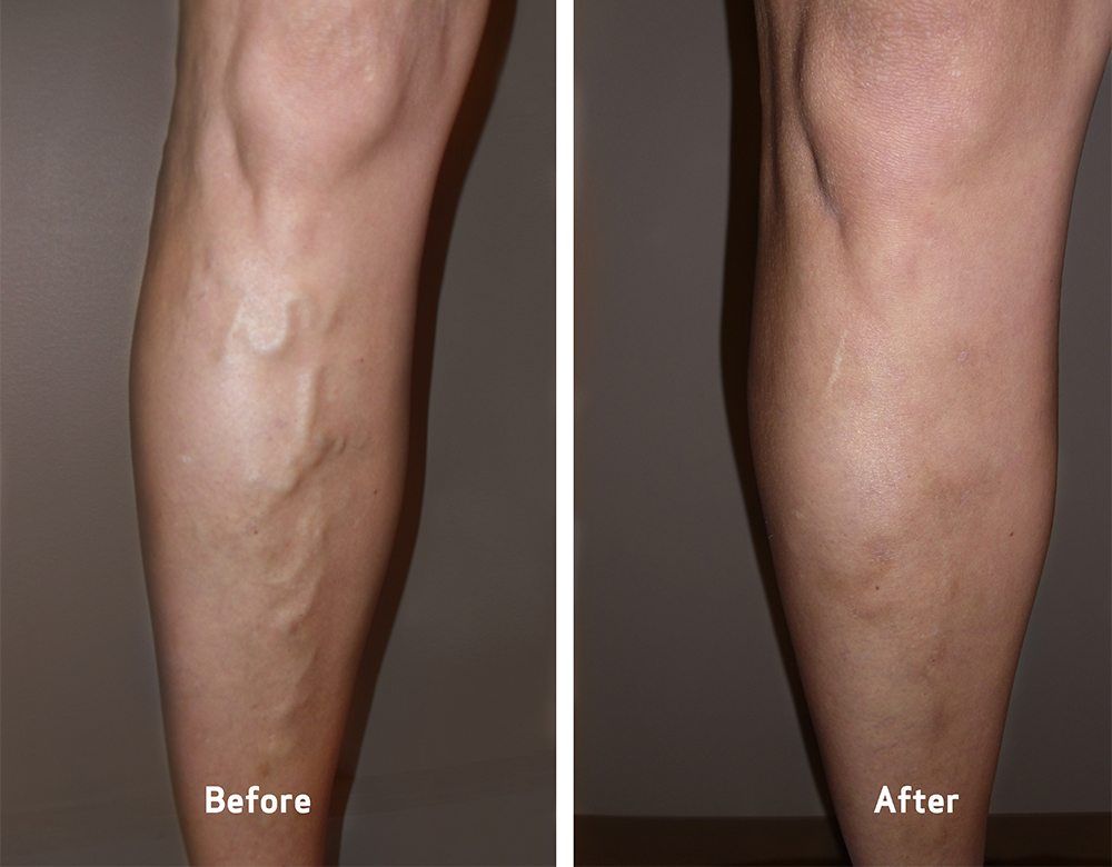 Essentials You Need To Know About Varicose Veins And Its Treatments