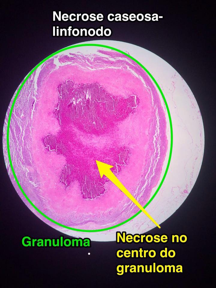 HISTOLOGIA90: TIPOS DE NECROSE
