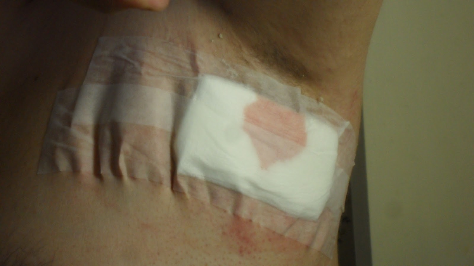 El Mundo de Largo: Absceso en la axila