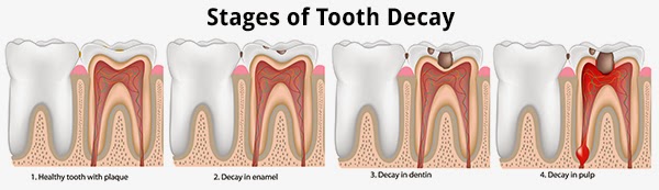 Best Dental Care In Kerala | Dental Specialities Centre: Root Canal ...