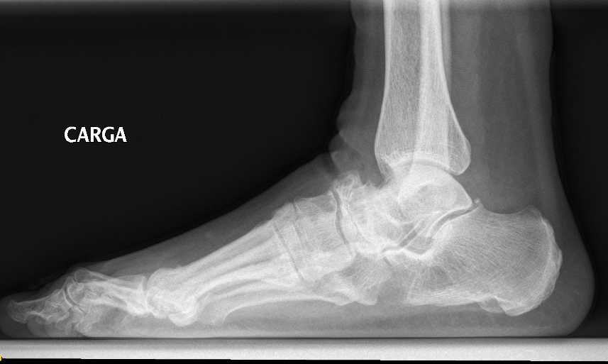 Fanáticos del pie: ATLAS DE PATOLOGIA DEL PIE: ENFERMEDAD DE MULLER-WEISS