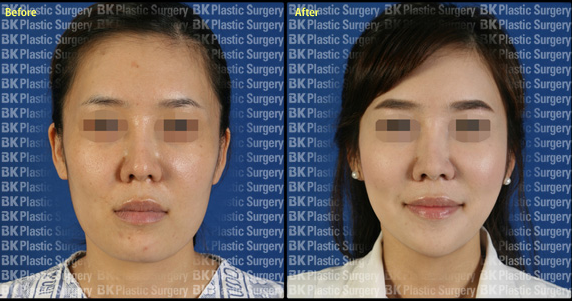 BK Plastic Surgery: [BK Plastic Surgery] How to have slender face