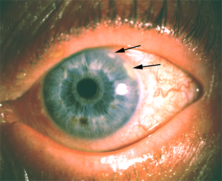 Photos For Chemosis ~ YOUNG DOCTORS' RESEARCH FORUM