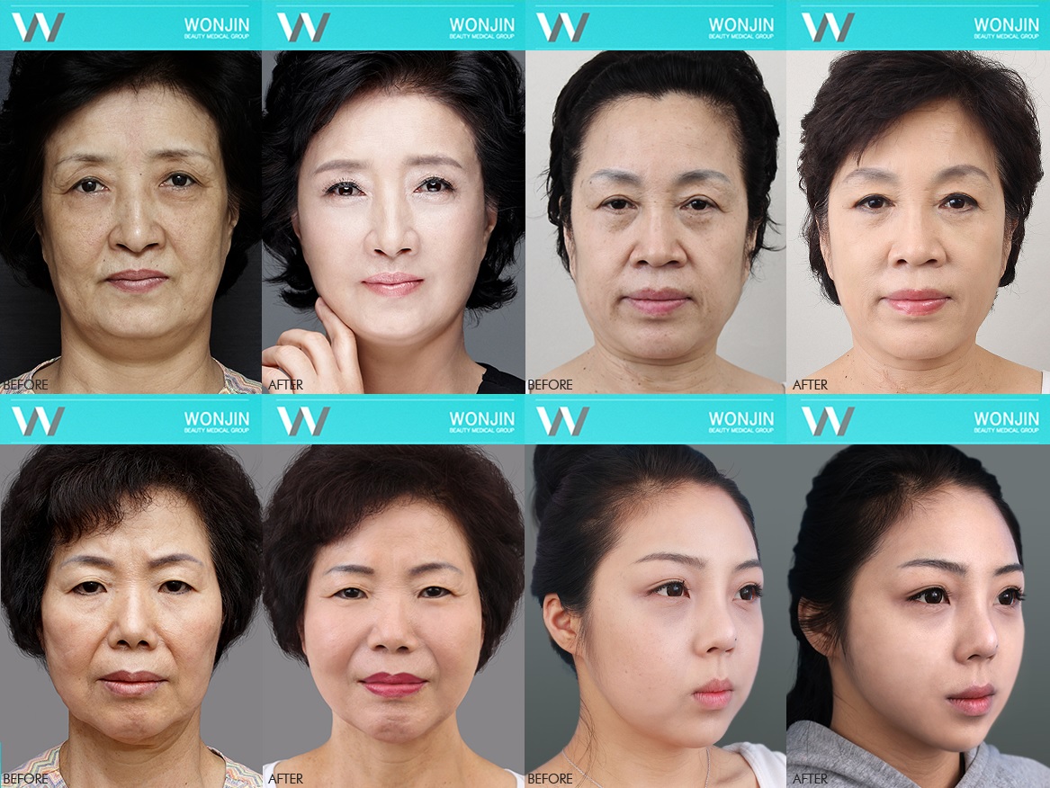 Apa itu operasi lifting wajah (Face lifting)