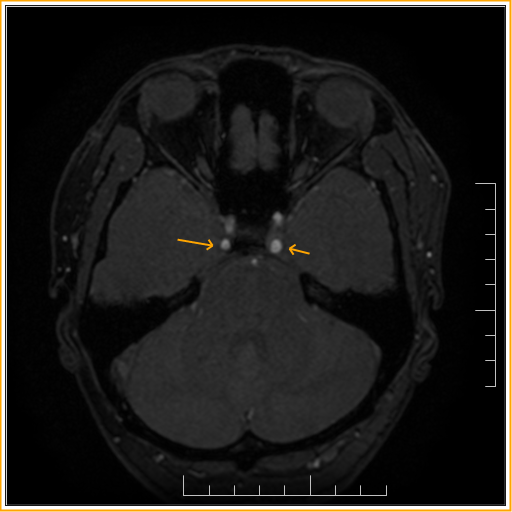 Tolosa-Hunt Syndrome-MRI - Sumer's Radiology Blog