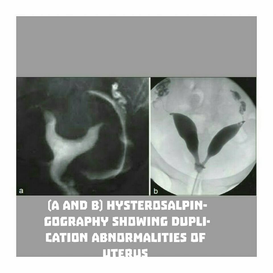 hysterosalpingography - Radiology Imaging