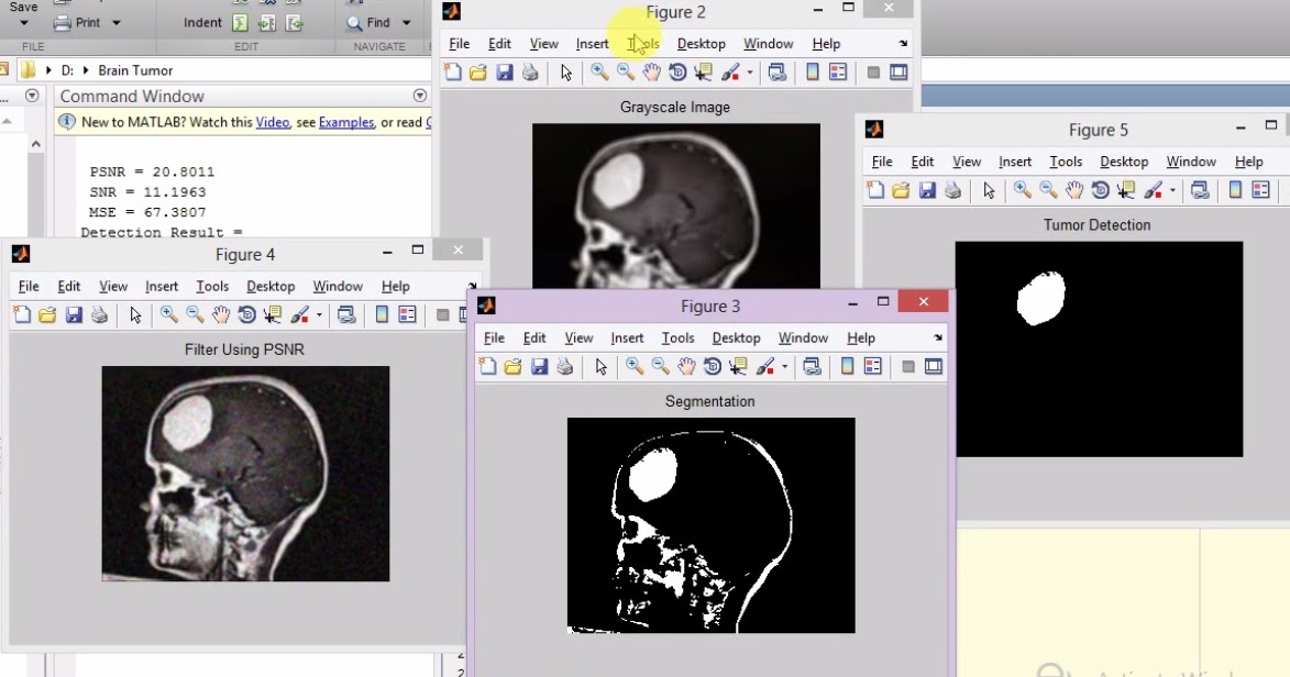 Matlab Code for Brain Tumor Detection and Classification Using Image Processing ~ ENGINEERING ...