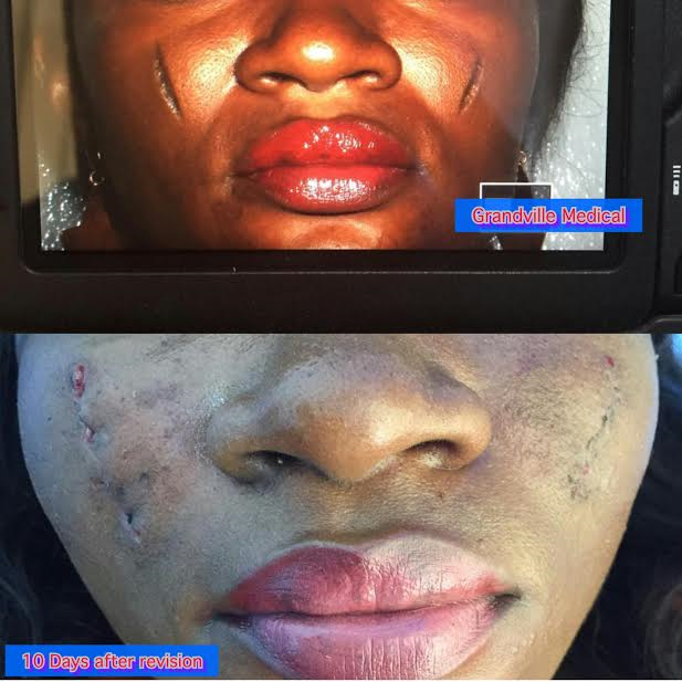 Battling With Stretch Marks Wrinkled Face Uneven Skin Excess Fat And battling-with-stretch-marks-wrinkled-face-uneven-skin-excess-fat-and