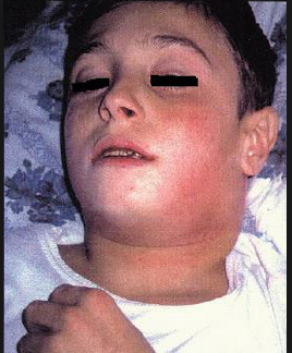 Open Up Ur Heart...: KLB Difteri