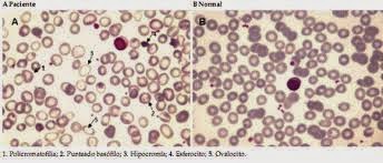 HEMATOLOGIA: TALASEMIA