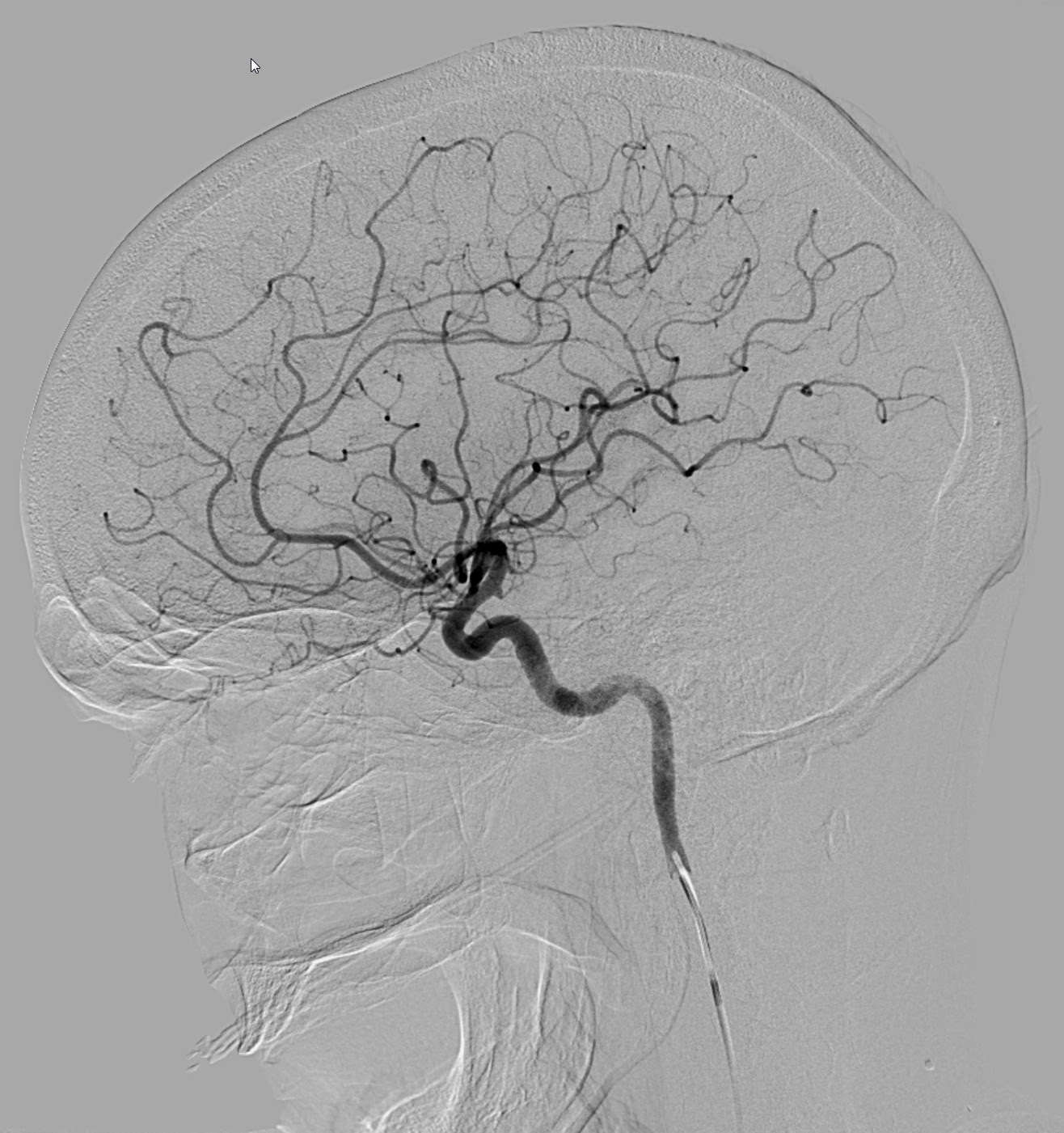 Coloured angiogram of the brain of a 48 year old patient after a stroke ...