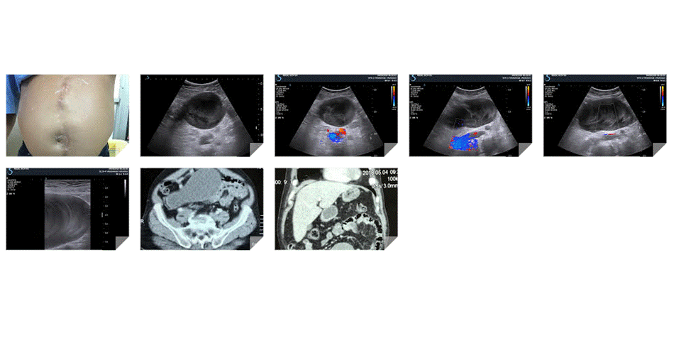 VIETNAMESE MEDIC ULTRASOUND: CASE 492 : APPENDICULAR MUCOCELE, Dr PHAN ...