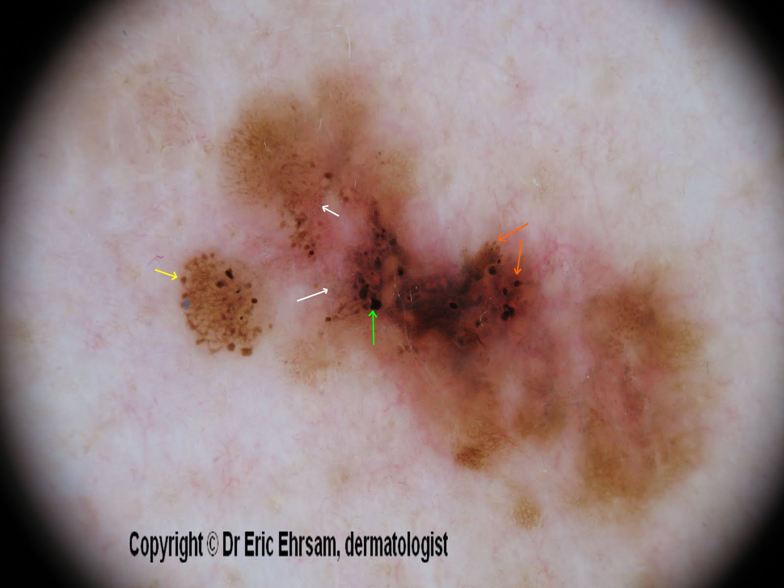 dermoscopy: July 2011