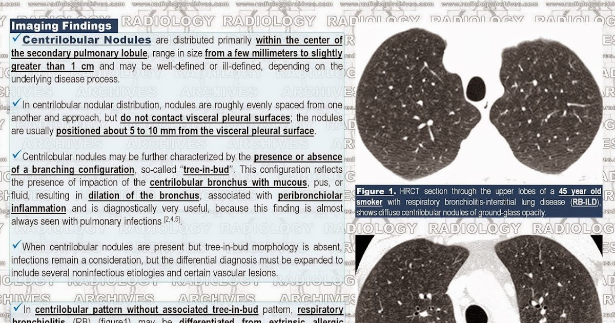 Radiology Archives: A guide to analyze Nodular Pattern in Interstitial ...