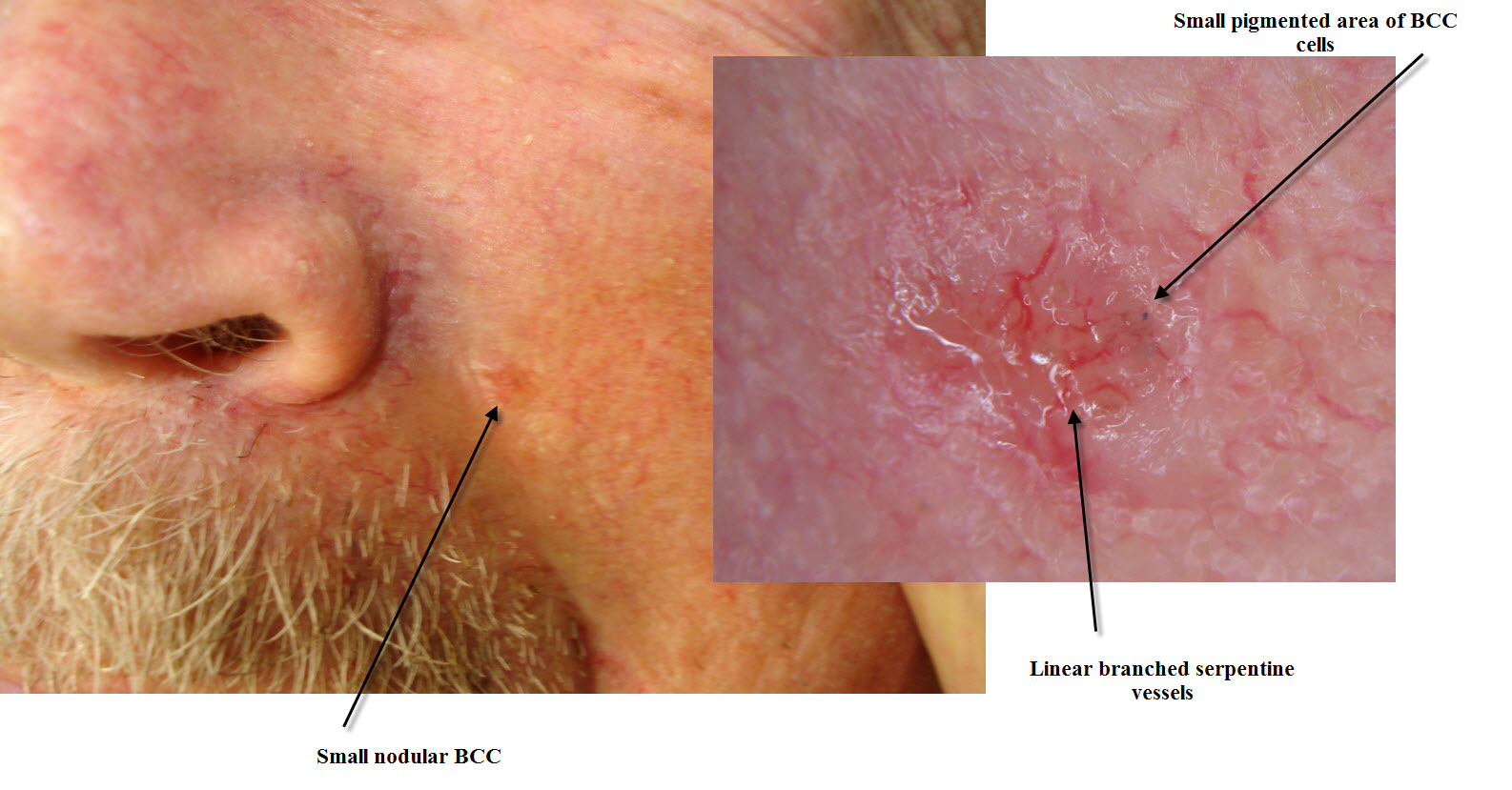 Dermpath Made Simple - Neoplastic: Basal Cell Carcinoma