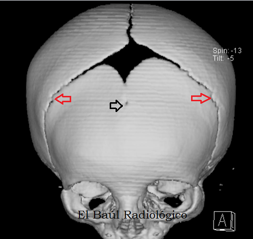 El Baúl Radiológico: CRANEOSINOSTOSIS. CIERRE PREMATURO DE LAS SUTURAS ...