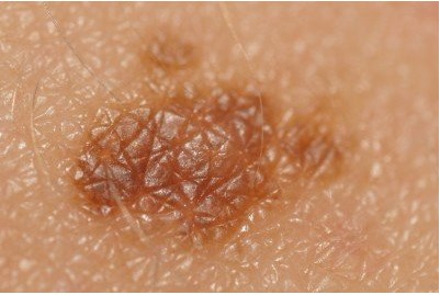 Conoce las características principales de los lunares cancerosos ...