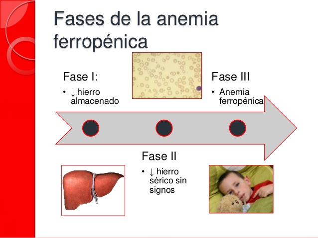ANEMIA