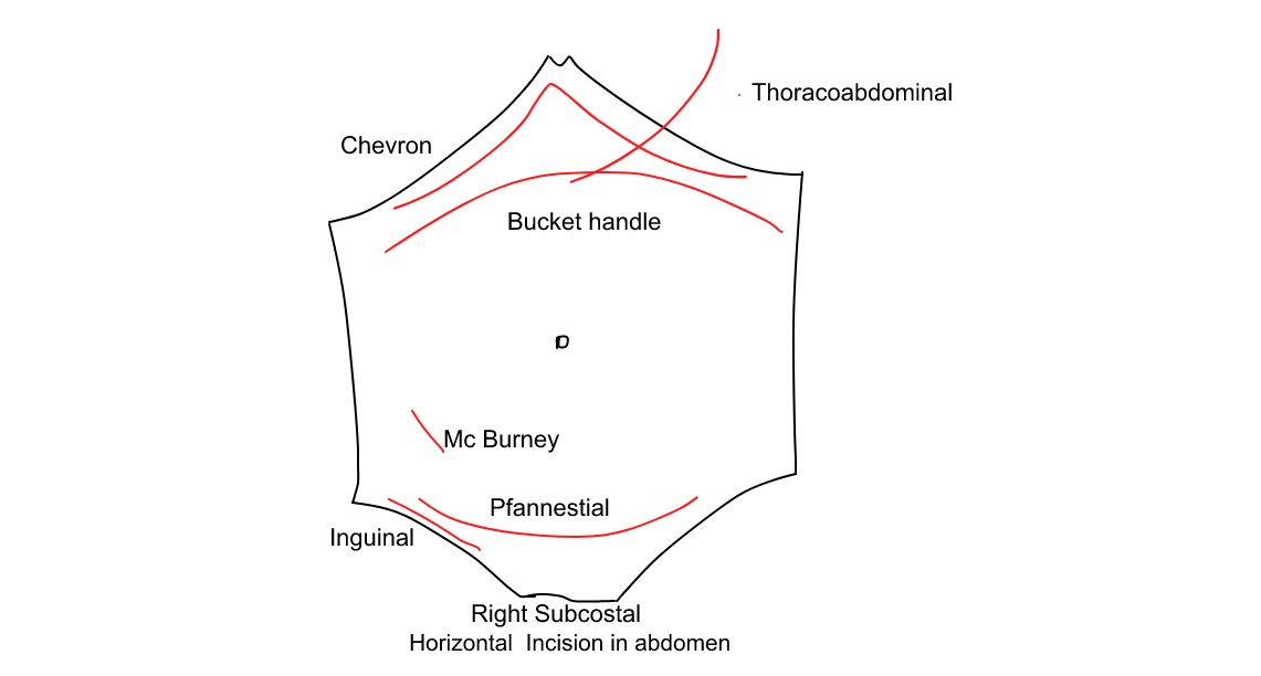 My notes: Its How I graduated Medical School.: Surgical Incision in ...