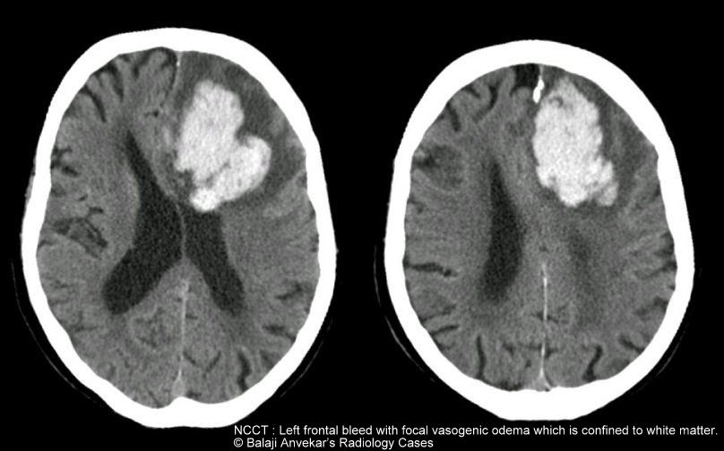 Neuroradiology Cases: Cytotoxic vs Vasogenic odema