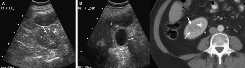 Renal Ultrasound Cases (Adrenal haemorrhage, Perinephric haematoma ...