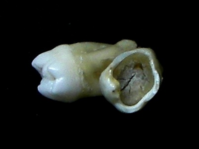 Deformutilation: Concrescence - Tooth Fusion
