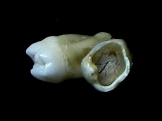 Deformutilation: Concrescence - Tooth Fusion