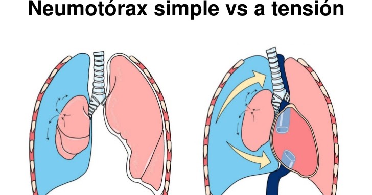 Desviación de la traquea