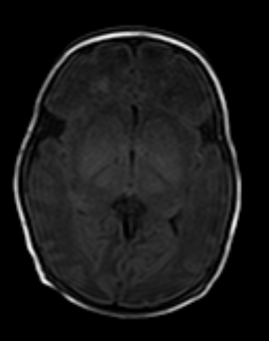 Periventricular leukomalacia -MRI - Sumer's Radiology Blog