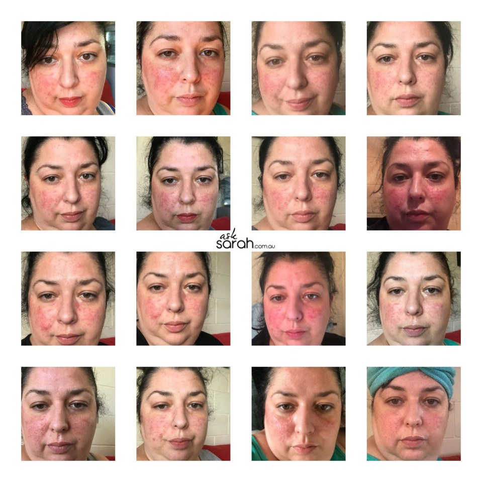 Scarlet Letters, dealing with vascular rosacea, face flushing, burning ...