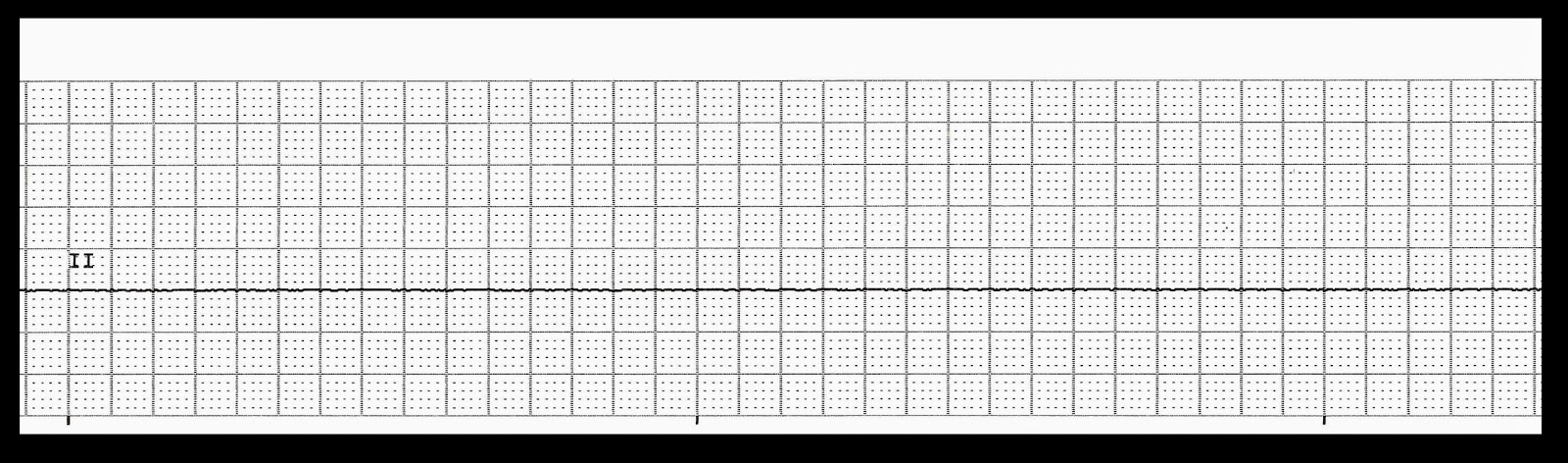 Basic EKG Rhythm Test 18