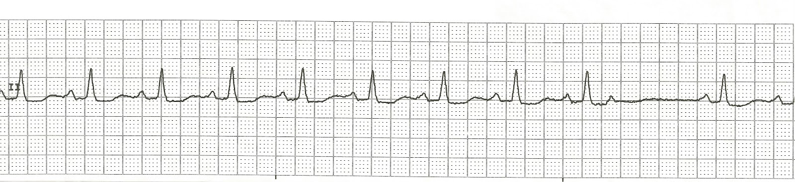 EKG Rhythm Strip Quiz 90