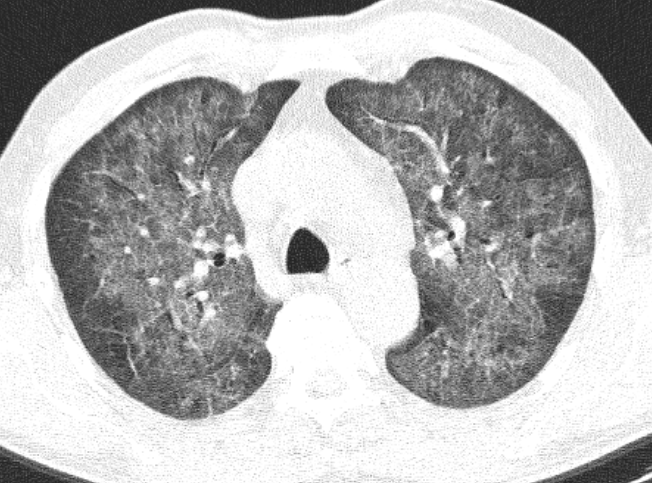 Pneumocystis Carnii-CT - Sumer's Radiology Blog