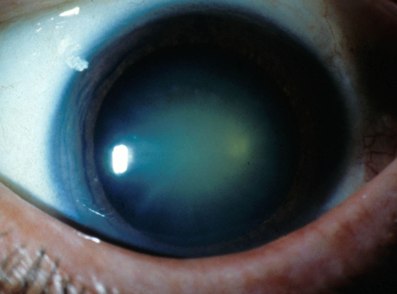 Deformutilation: Cataracts