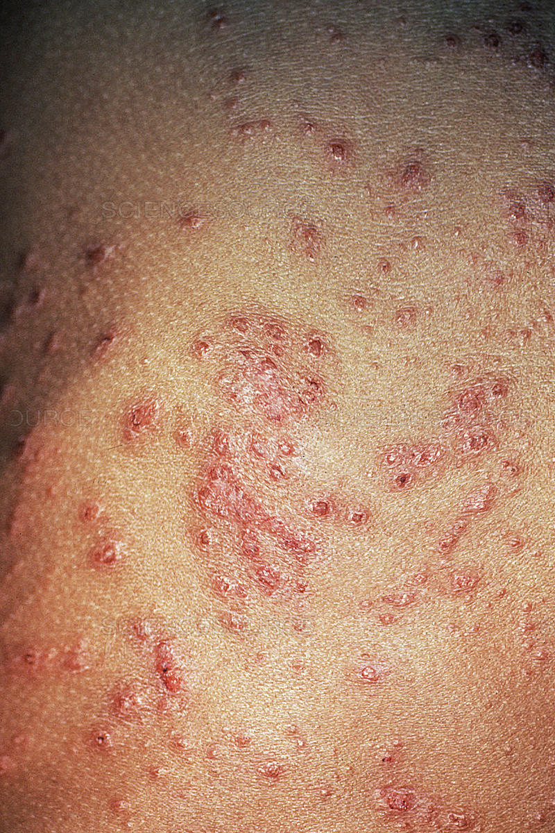 BLOG DIAGNOSIS DERMATOLOGICA: ¿Qué es la Dermatitis atópica?