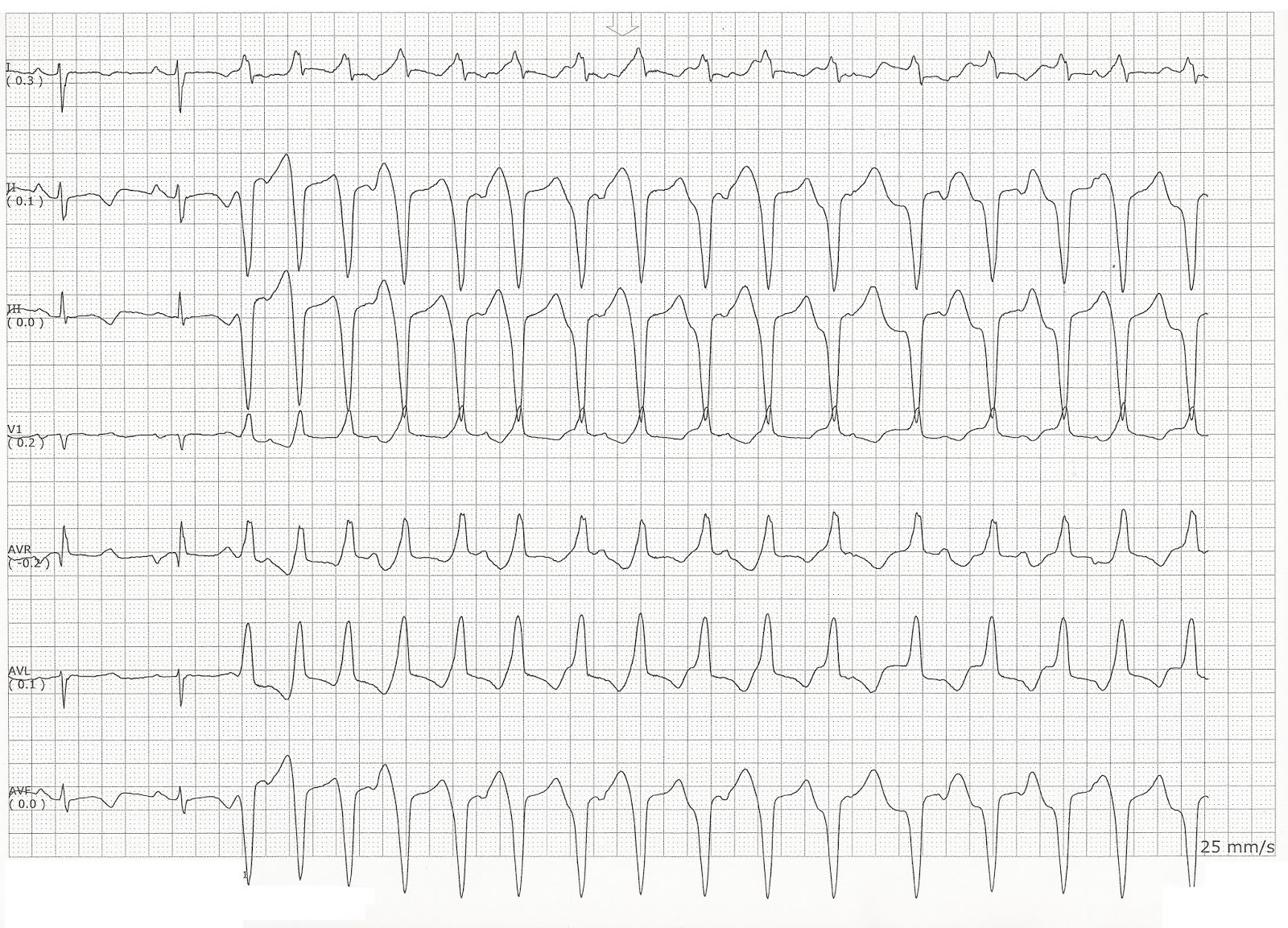 Float Nurse: Long Run of Ventricular Tachycardia