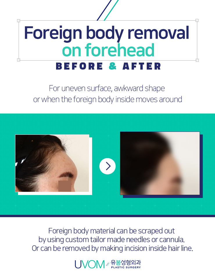 UVOM Plastic Surgery Foreign Body Removal