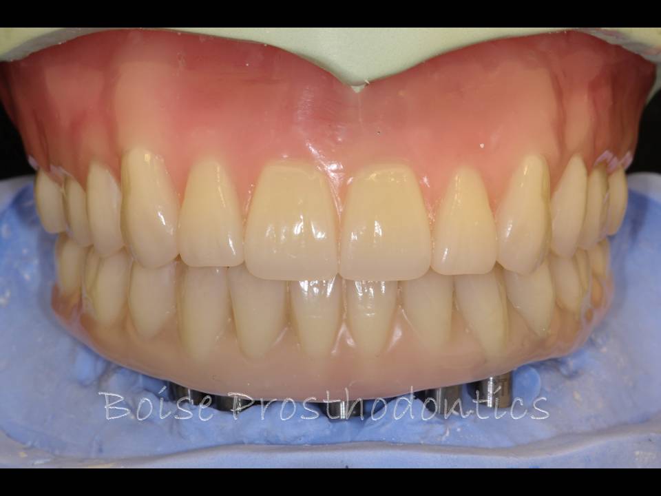 Boise Idaho Prosthodontics: Picture Sequence of Maxillary Complete ...