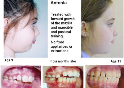Pretty in Primal: Epigenetic Orthodontics: Building Better Bites, Faces ...