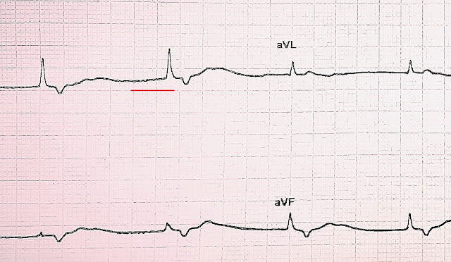 ECG Challenge 3 - Inverted waves
