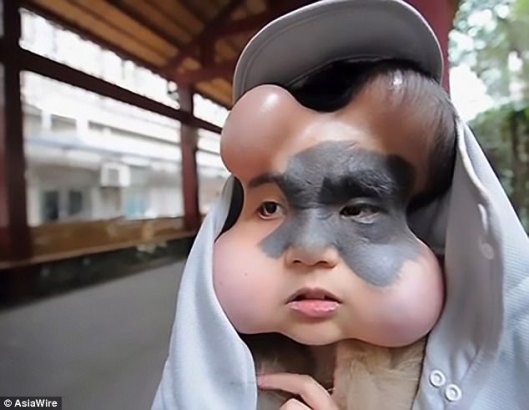 This Woman Has 4 Balloons Implanted In Her Face To Save Her Life (Photos)
