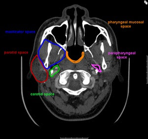 Radiologist For Ever: Parapharyngeal space rule 1:Anatomy and pathology
