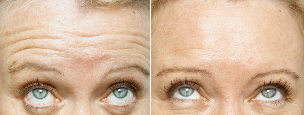 Strengthen Face Skin And Jowls Using Facial Aerobics: Facelift ...