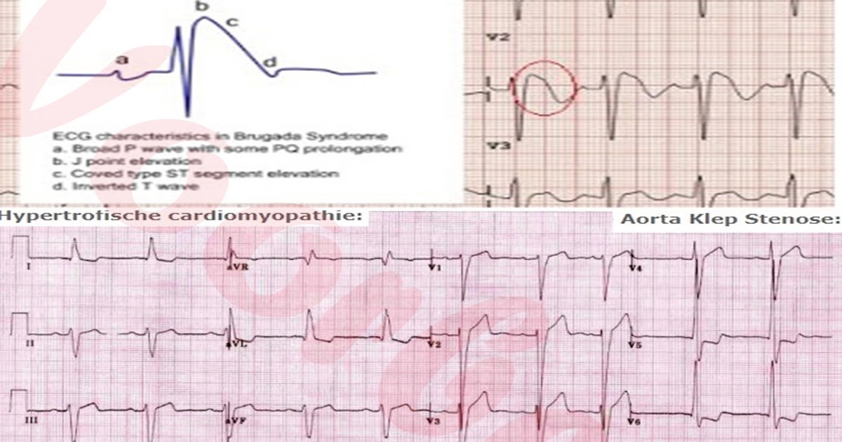 Shop: Acute Zorg Kaartjes: WOBBLER/EKG - Acute Zorg Blog