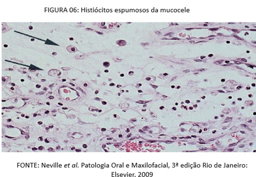 Atlas virtual de histologia e patologia: [CC II: #4] MUCOCELE