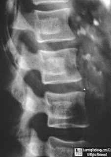 Tecnicos Radiologos: Hallazgos Radiológicos de osteitis por radiación ...