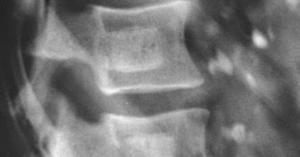Tecnicos Radiologos: Hallazgos Radiológicos de osteitis por radiación ...
