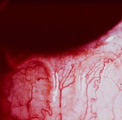 4 Gambar Cacing Hidup Dalam Mata - Harian Metro Online